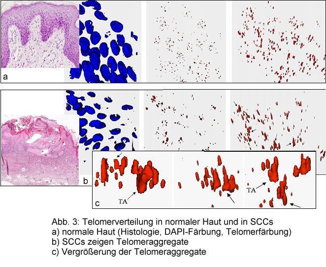 Genetics of Skin Carcinogenesis: Heidelberg University Hospital
